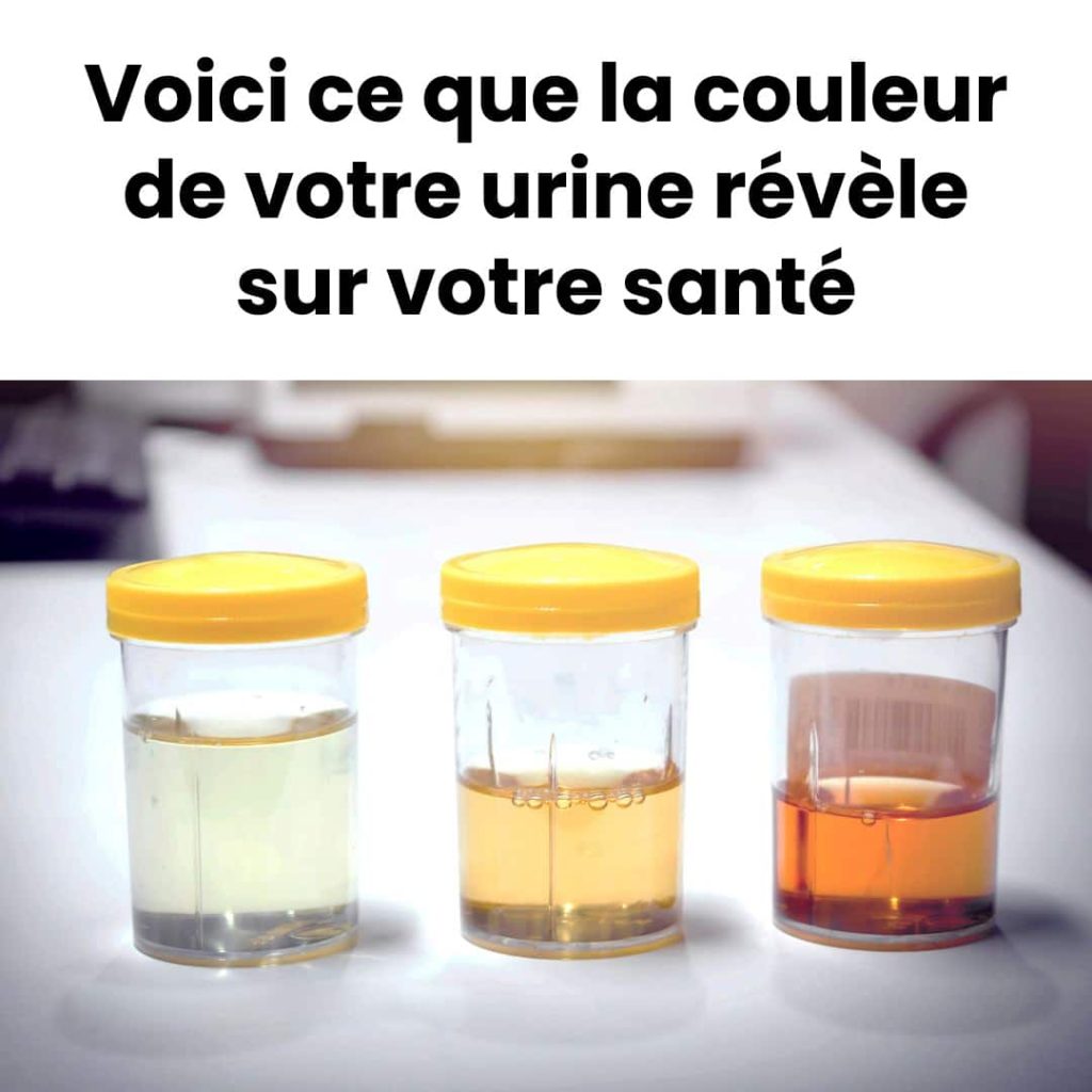 Les indices cachés de votre santé révélés par la couleur de votre urine ...